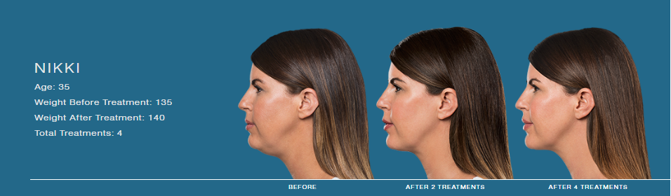 How Much Does Kybella Cost? | Guilford Kybella | The Langdon Center