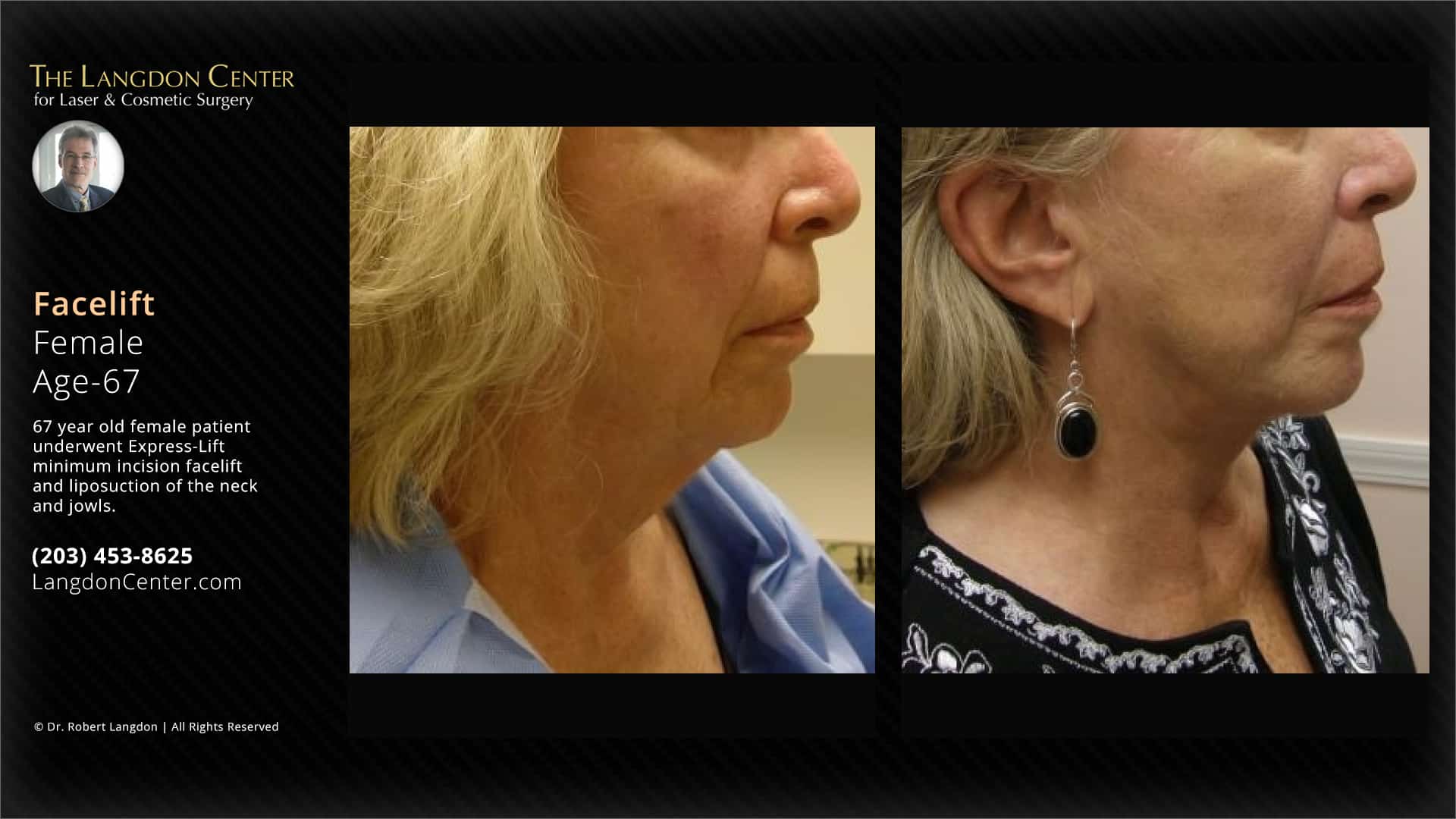 Rejuvenate Your Appearance with a Facelift by Langdon Center