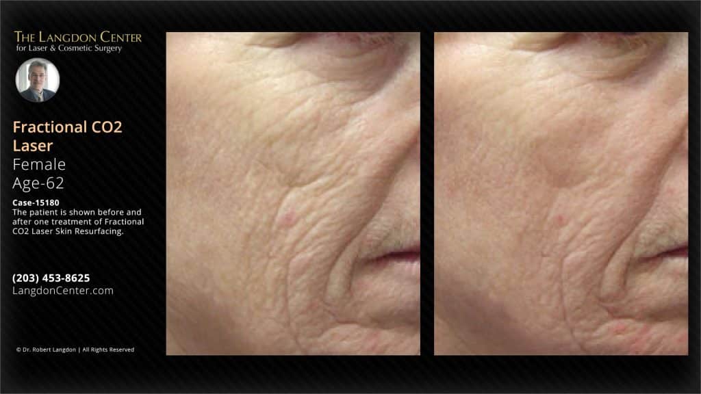 Best Fractional CO2 Laser Treatment | Top Skin Rejuvenation Experts ...