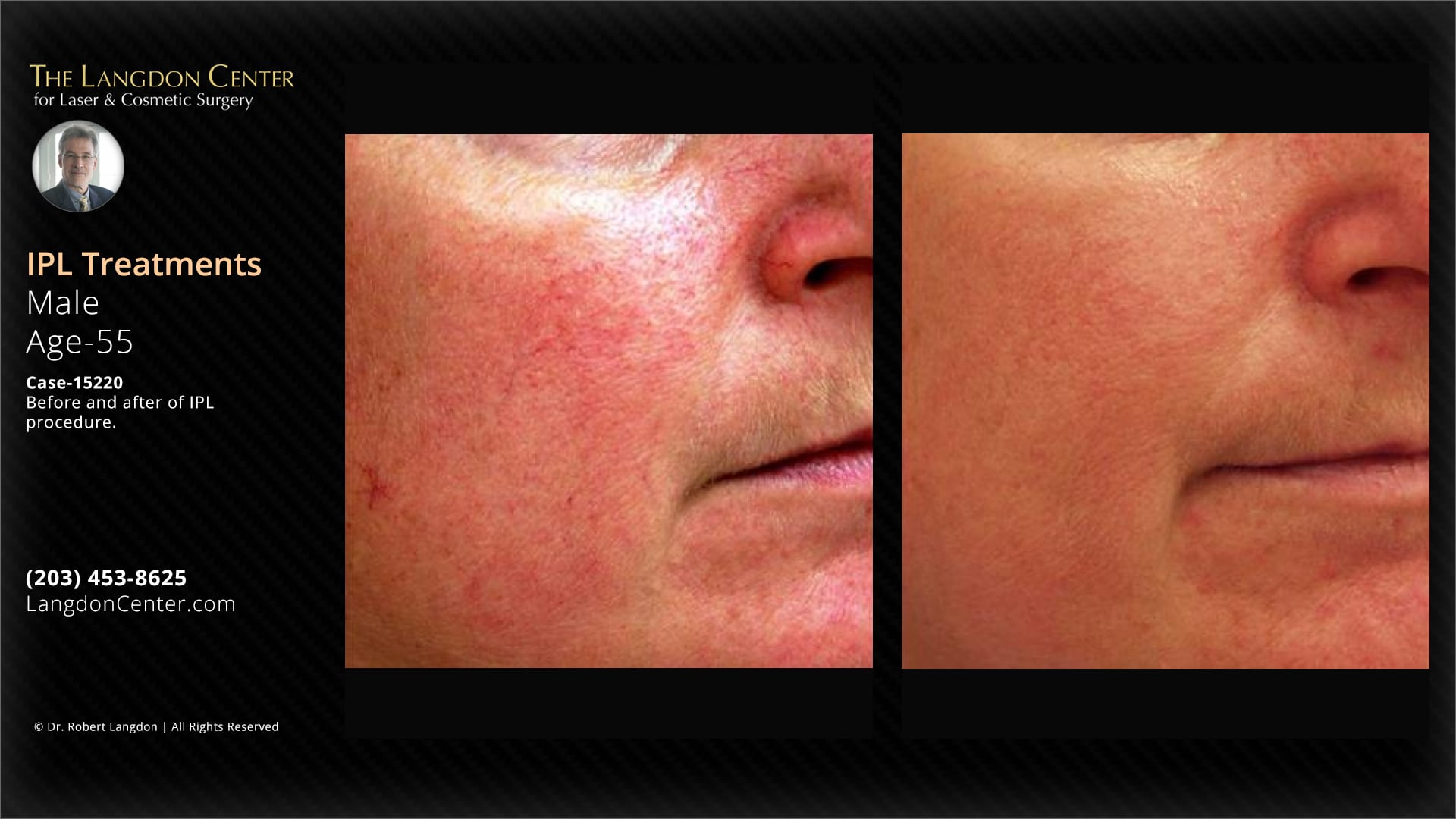 IPL Treatments - The Shoreline Center for Laser & Cosmetic Surgery