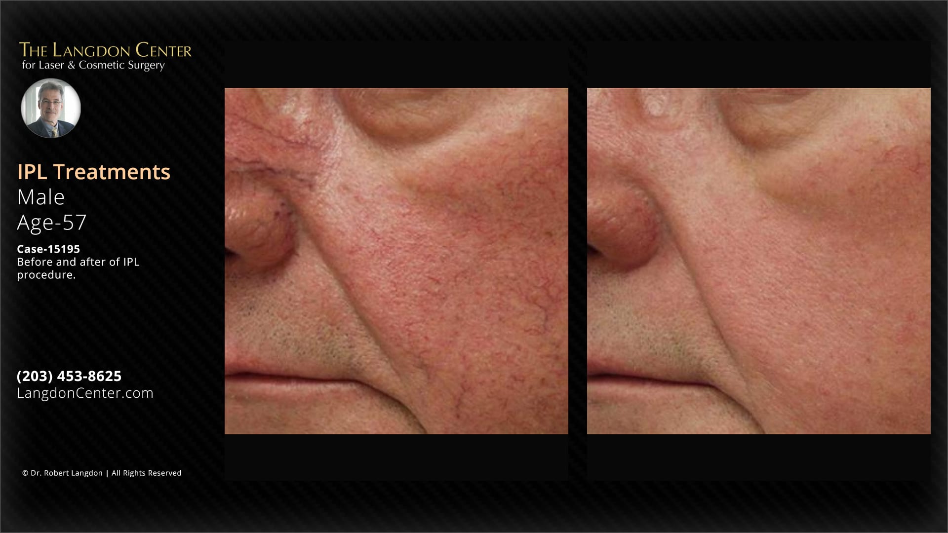 IPL Treatments - The Shoreline Center for Laser & Cosmetic Surgery