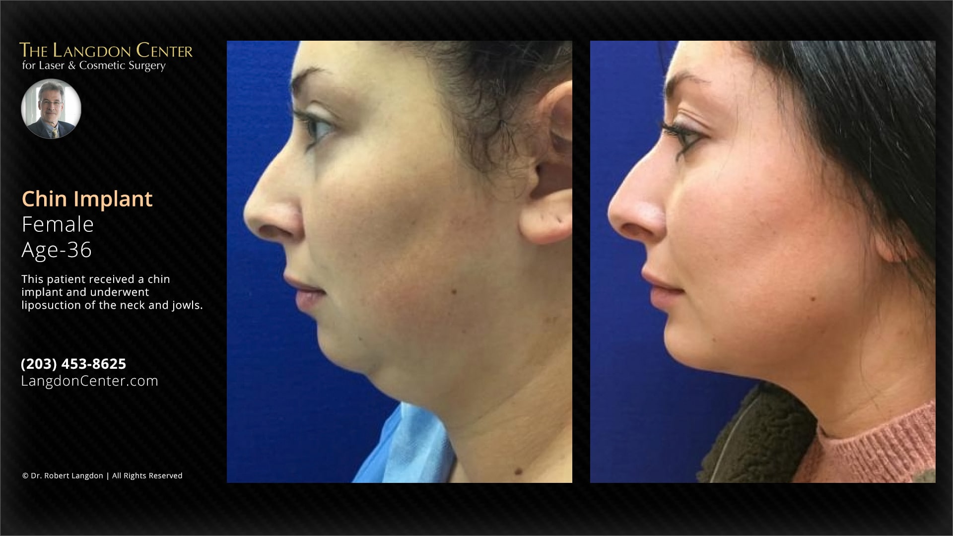 How Much Does Chin Augmentation with Implant Cost? | CT Chin Implant ...